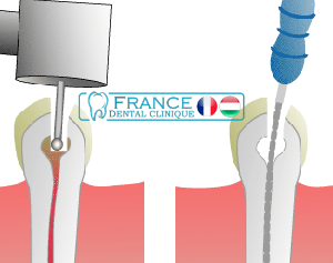 Dévitalisation dentaire – France Dental Clinique