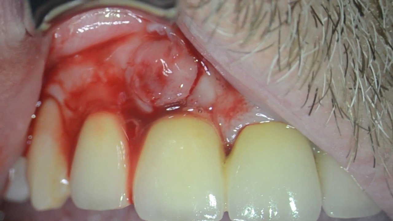 En combien de temps disparaît un abcès dentaire ? Guide France Dental ...