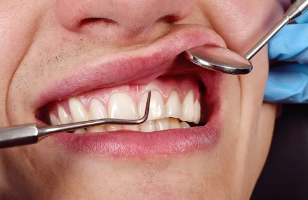 Gencive gonflée après dévitalisation : Causes et Solutions