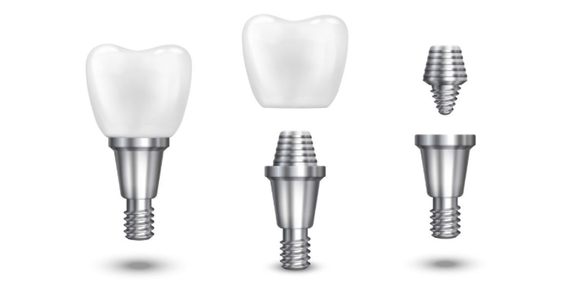 Vis d'implant dentaire tombé ? Guide urgent des solutions